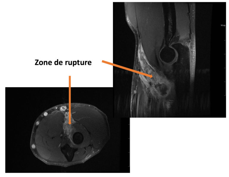 Les ruptures du biceps au coude, par les docteurs Bourgade et Tavernier