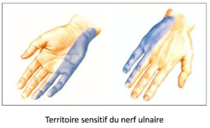 La compression du nerf ulnaire au coude, centre du membre superieur