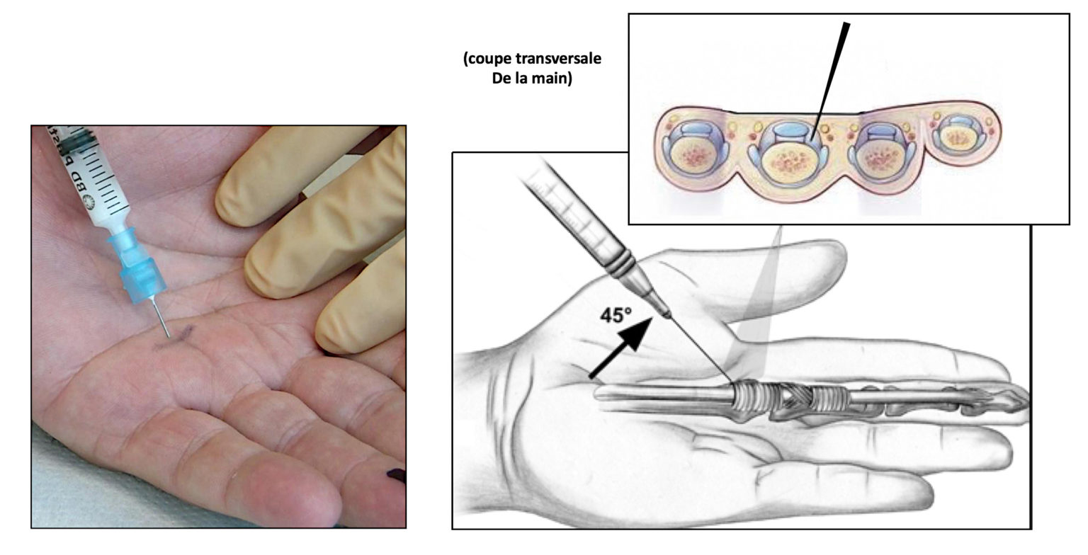 Les ténosynovites et doigts à ressaut, Centre du Membre Supérieur Trénel