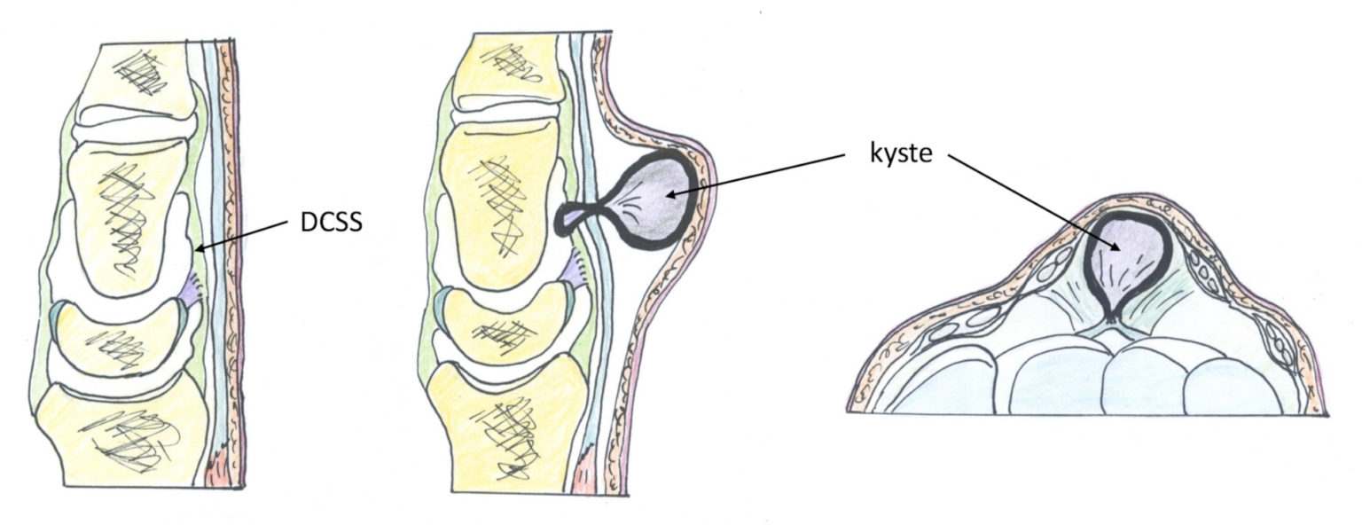 Les kystes synoviaux du poignet, Centre du Membre Supérieur Trénel (38)