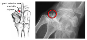 Les tendinites du poignet, Centre de Chirugie du Membre Supérieur Trénel