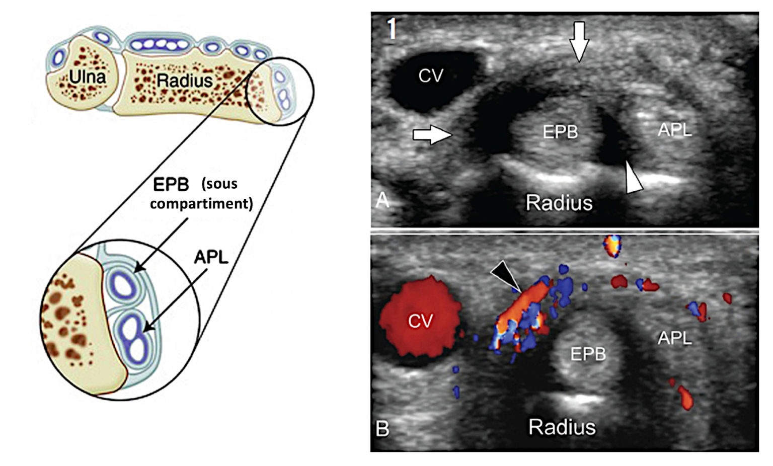 Les tendinites du poignet, Centre de Chirugie du Membre Supérieur Trénel