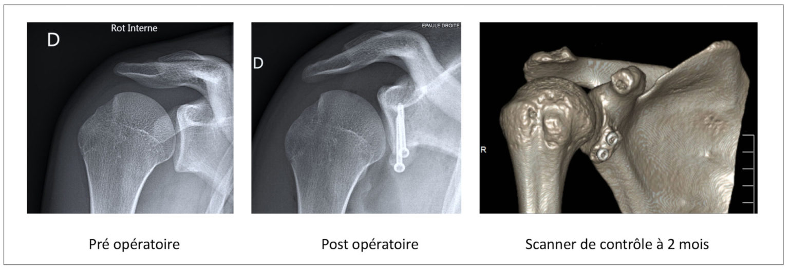 Luxations et instabilités de l'épaule, docteurs Bourgade et Tavernier