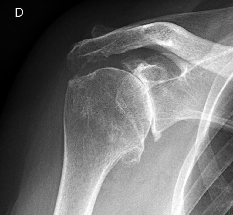 Omarthrose et prothèses de l'épaule, docteurs Bourgade et Tavernier