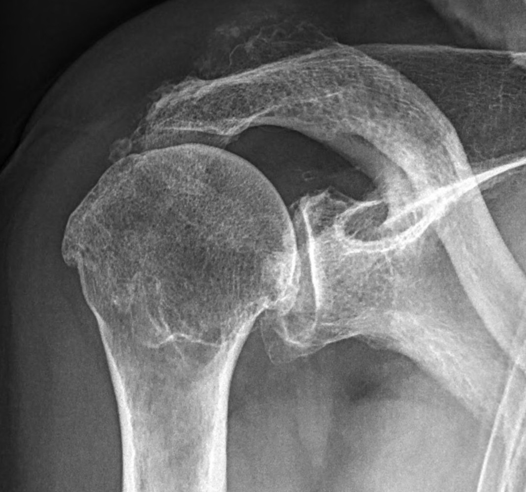 Omarthrose et prothèses de l'épaule, docteurs Bourgade et Tavernier