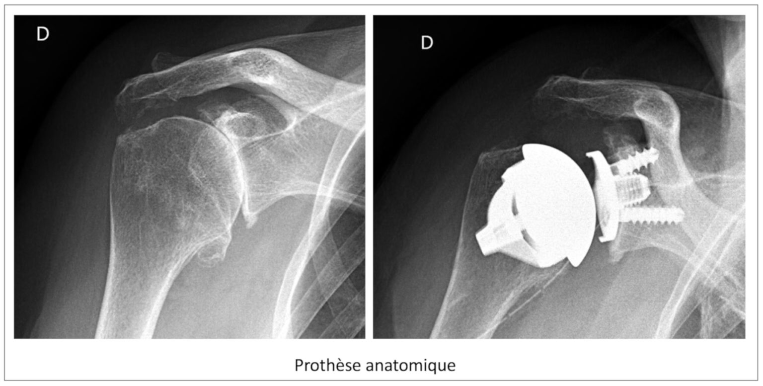 Omarthrose et prothèses de l'épaule, docteurs Bourgade et Tavernier